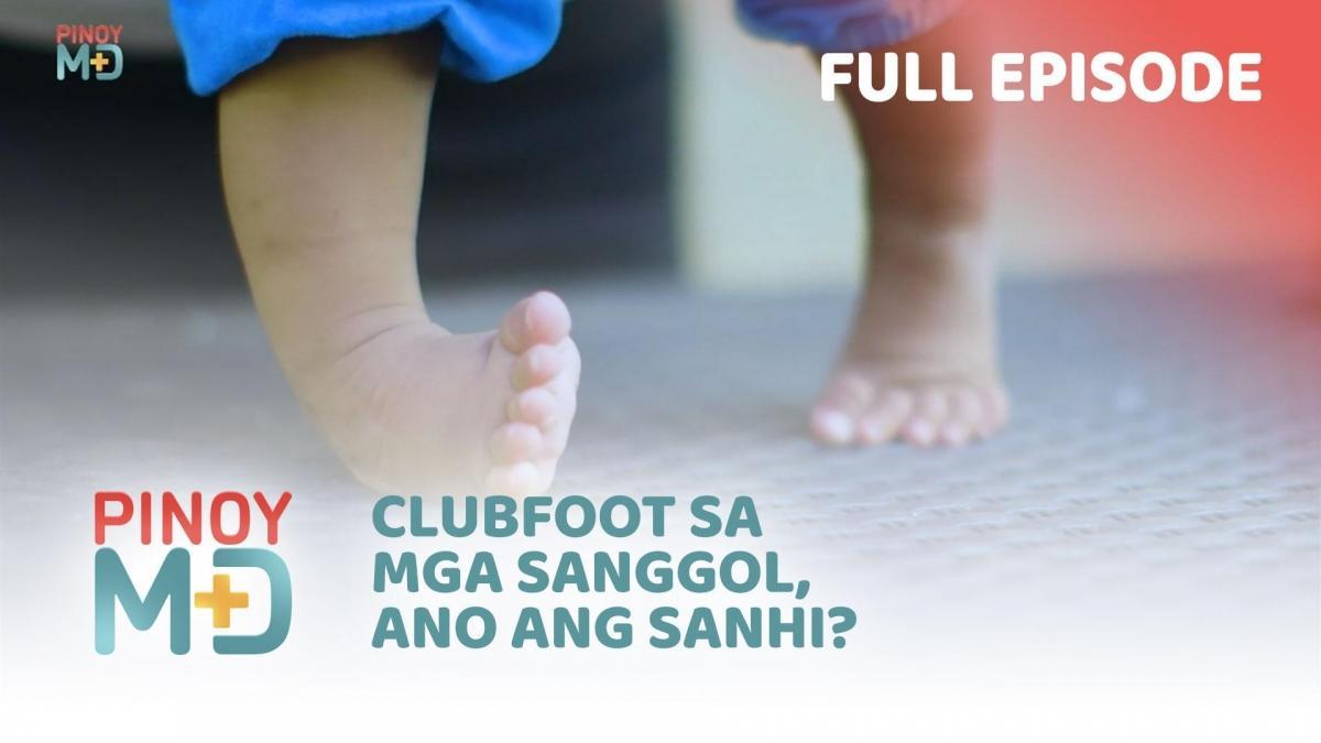 Clubfoot sa mga sanggol, ano ang sanhi? (Full Episode) | Pinoy MD | GMA ...