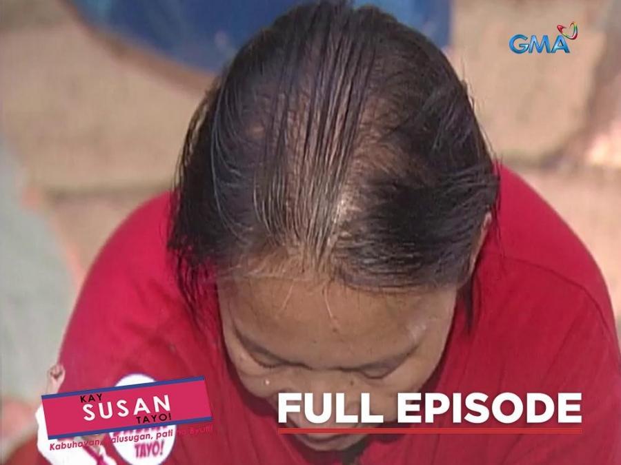 Pagkalagas ng buhok, may remedyo pa kaya? Full Episode 18 (Stream ...