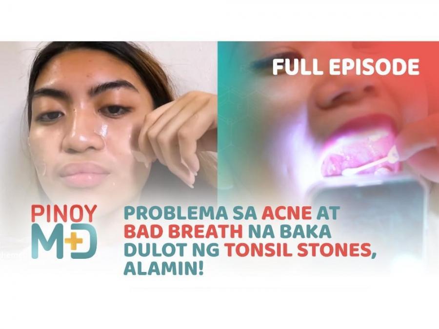 Solusyon sa acne at bad breath, alamin! (Full Episode) | Pinoy MD | GMA ...